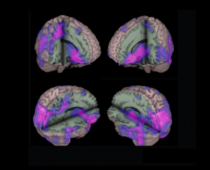 Brain Connectivity Study Could Lead to Better Outcomes for Epilepsy ...