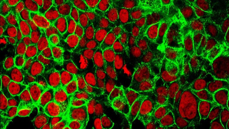 ‘Undruggable’ Cancers Slowed by Targeting Growth Signals | UC San Francisco