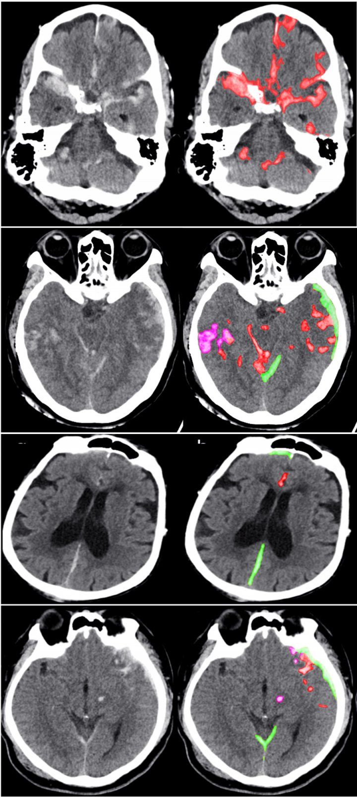 AI Rivals Expert Radiologists at Detecting Brain Hemorrhages | UC San ...
