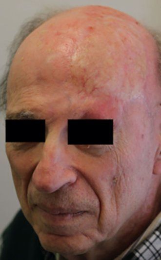 Surgical Procedure Helps Cancer Patients Face Themselves Again | UC San ...